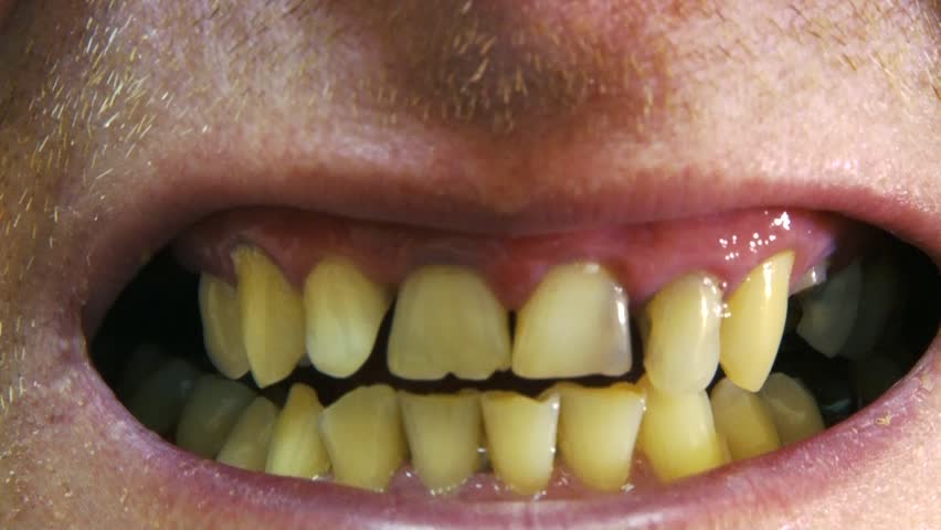 Yellow Bad Teeth. Periodontal Disease. Stock Footage Video (100% ...