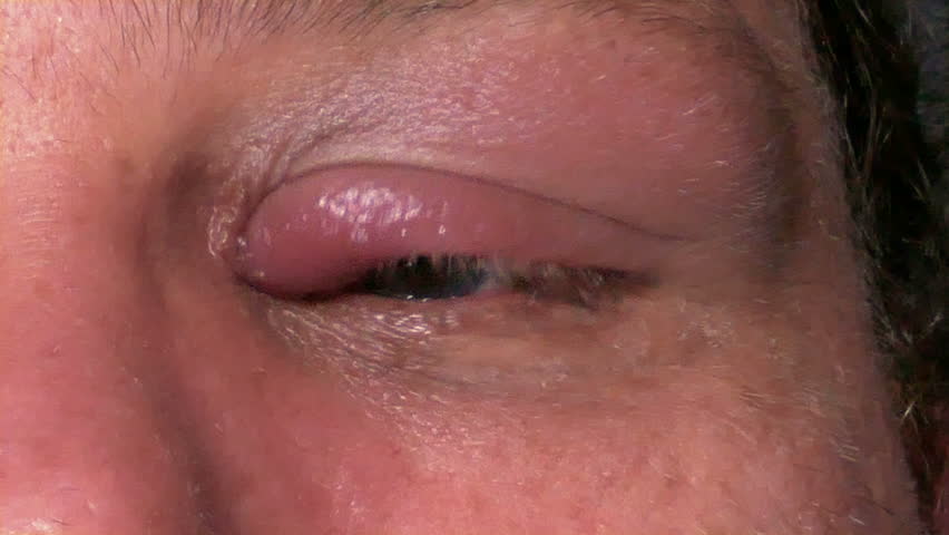 Man With Infected Eye Uncomfortable, 4K Stock Footage Video 14192003 ...
