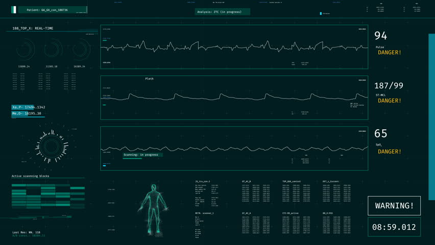 Patient's Revival, ICU Monitor With Vital Signs Rising After Cardiac ...