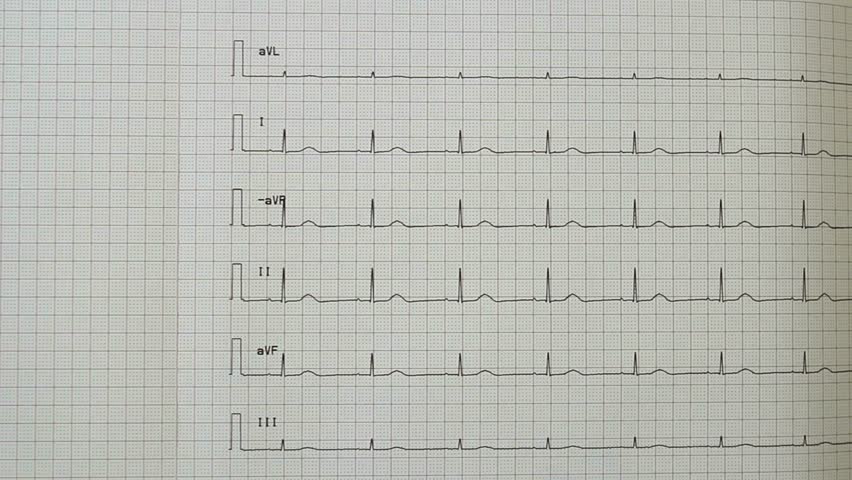 Ekg Readout Displays Patient’s Heart Stock Footage Video (100% Royalty ...