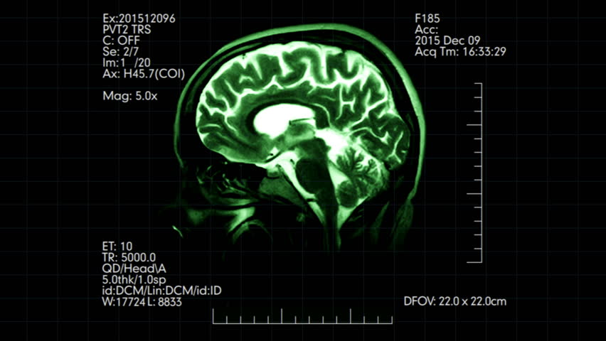 Bi-color Blue And Orange Side View Mri Brain Scan With Medical Data ...