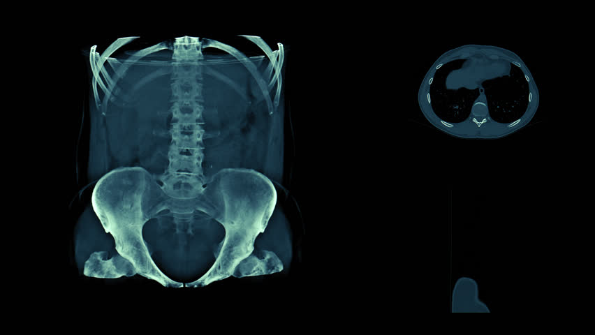 Body CT Scan Image, Radiography X-ray Examination, MRI Tomography ...