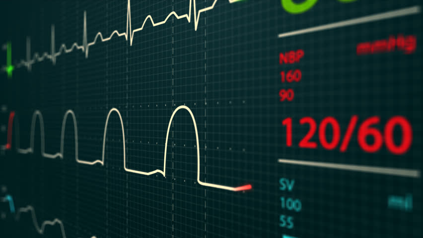 Animation Of Schematic Intensive Care Unit Monitor Showing Normal ...