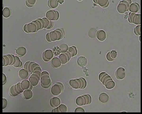 Red Blood Cells And Platelets Clumping Together On Microscope View ...